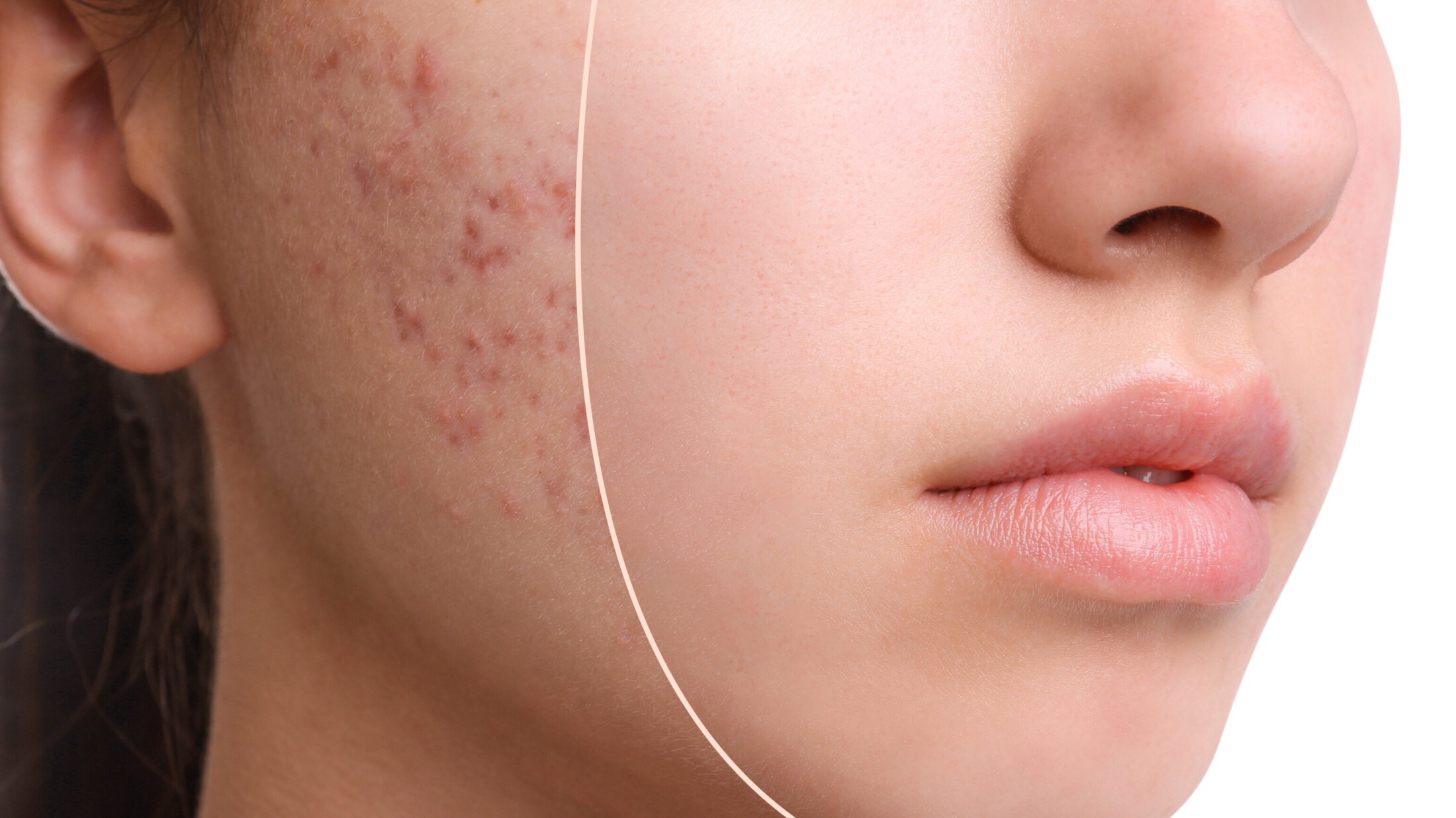 Akne - Warum sollte Akne immer dermatologisch behandelt werden? | KroneMED