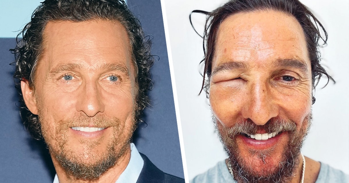 Ouch! - McConaughey shocks fans with disfigured face | krone.at