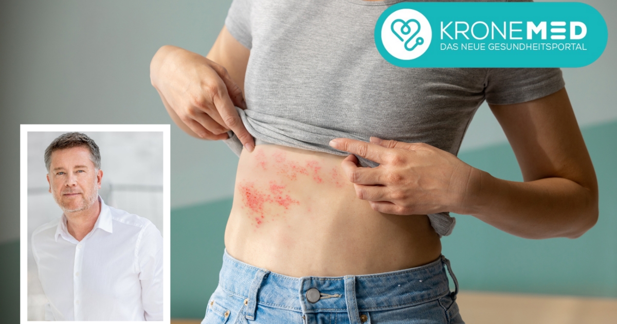 Questions and answers - I have shingles – what should I know? | krone.at